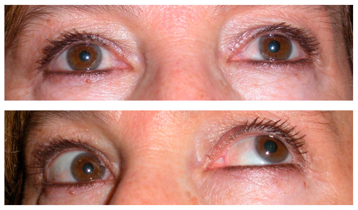 Se me desvían los ojos de una forma rara... - Blog del oftalmólogo ...