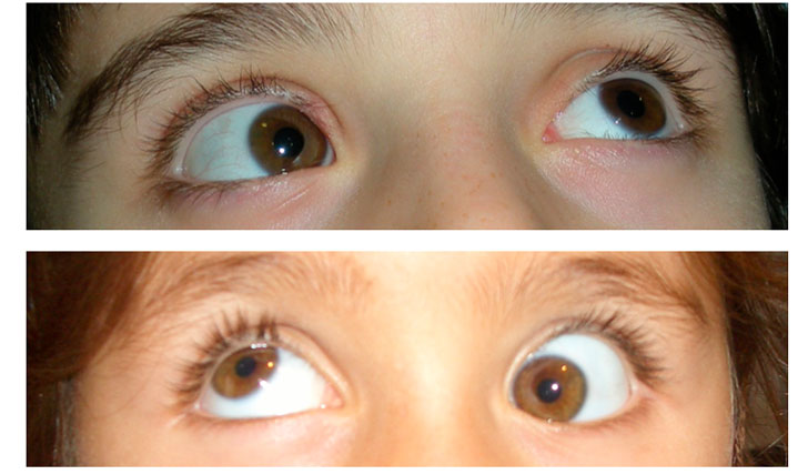Se me desvían los ojos de una forma rara... - Blog del oftalmólogo ...
