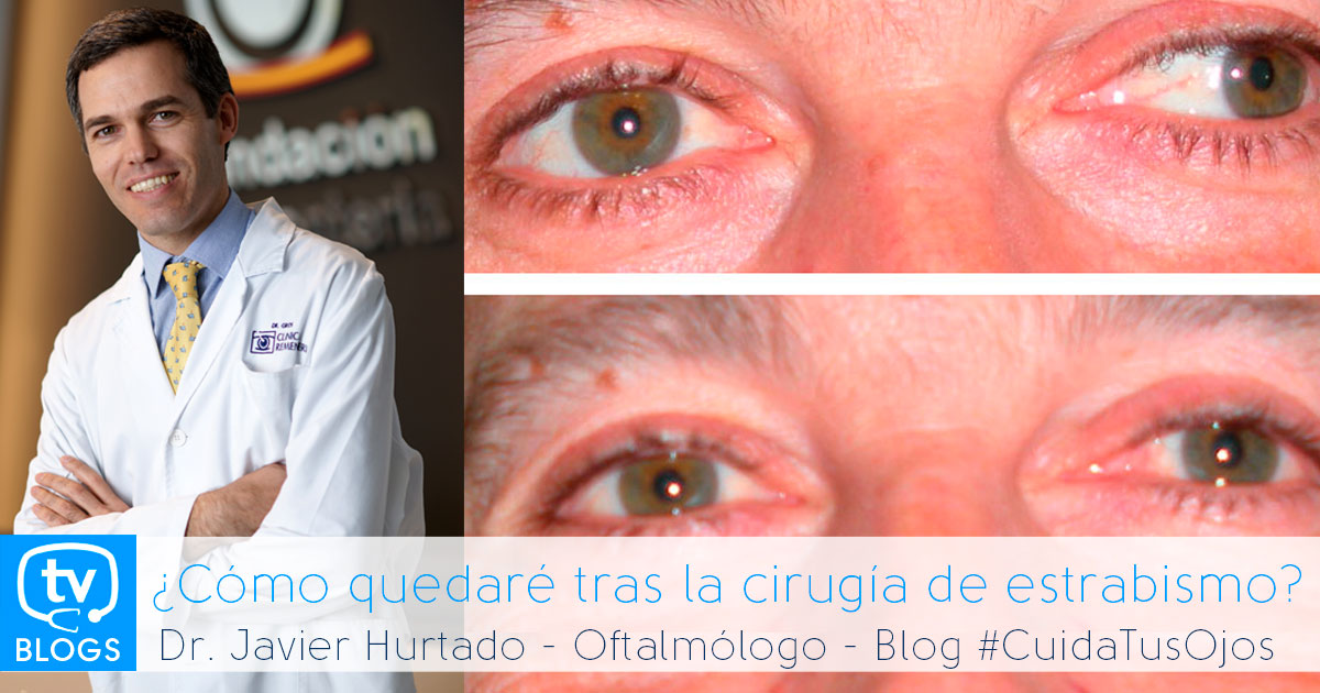 ¿Cómo quedaré después de la cirugía de estrabismo? - Blog del oftalmólogo Francisco Javier Hurtado